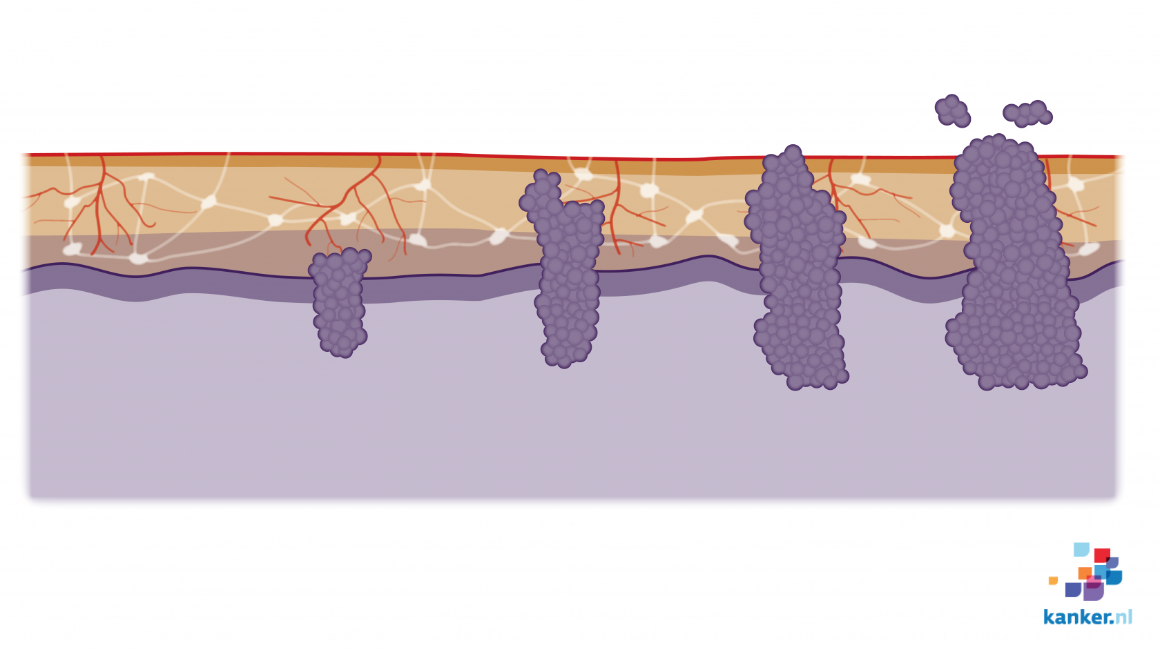 Oorzaken en risicofactoren van endeldarmkanker